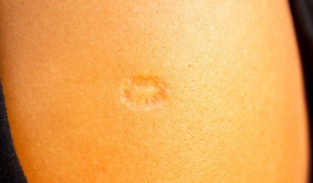 Here's what the "scar on your arm" signifies - Weveryday Stories